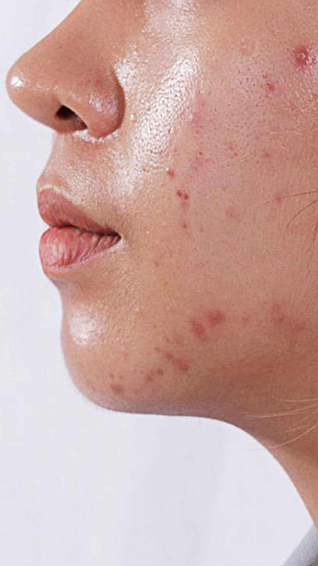 کرم ضد جوش آکنه اتک ضد جوش و جای جوش – No Acne